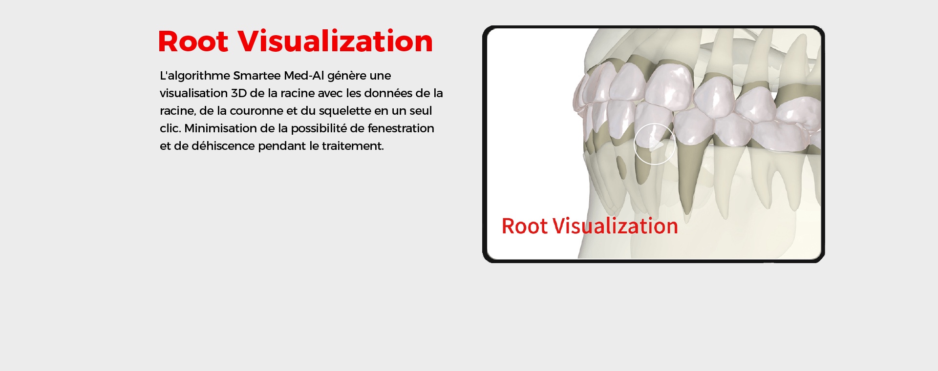 Smartee Clear Aligner