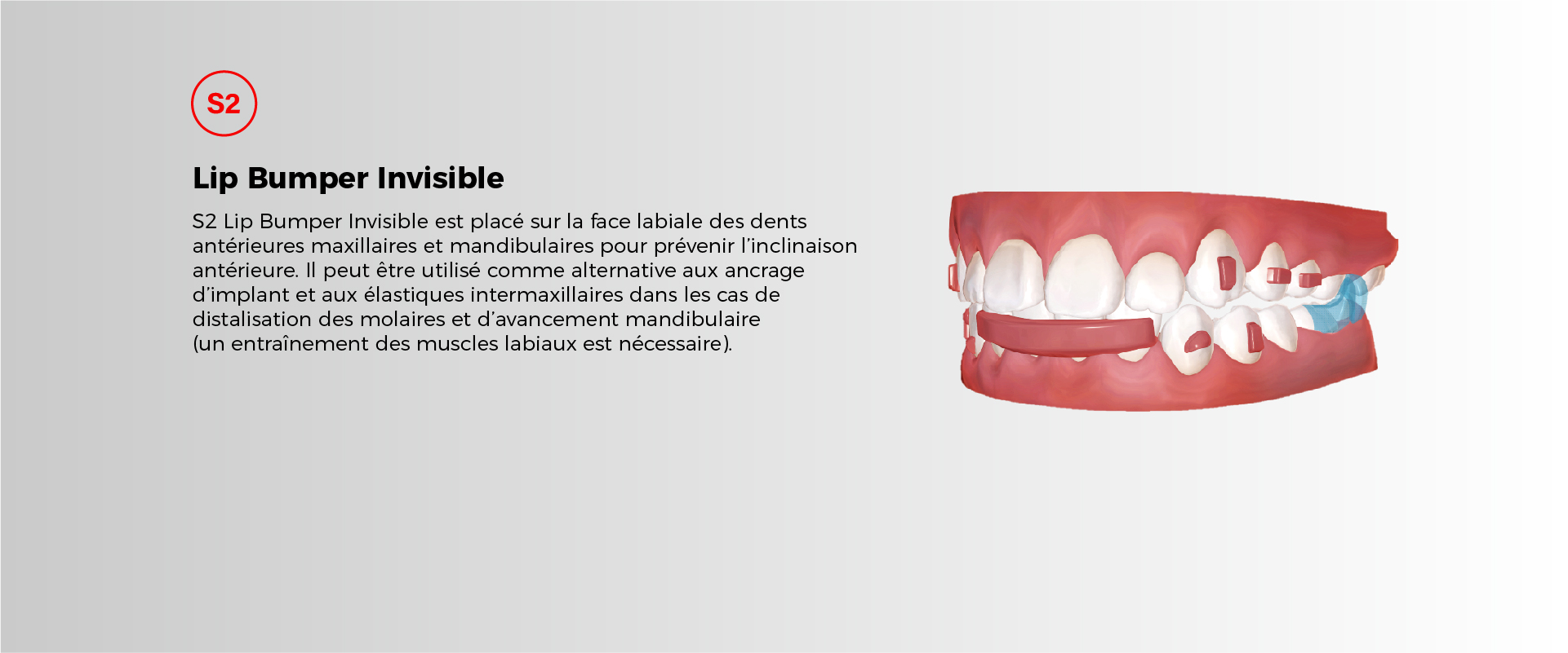 Smartee Clear Aligner